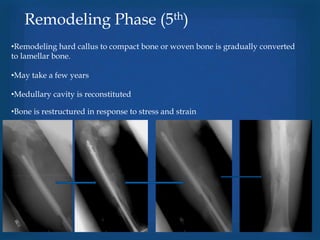 Fracture Healing.pptx