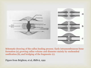 fracture healing.pdf traumatology mbbs md | PPT