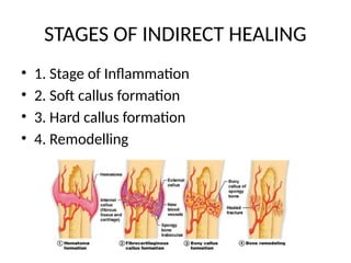 healing of fracture in adult bone and complications | PPTX