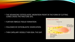 Fracture healing and growth factors | PPT