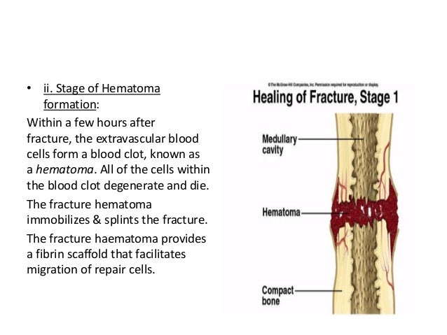 Ppt Bone Histology Fracture Healing Powerpoint