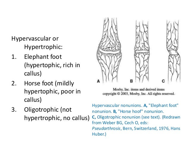 Fracture healing and wound healing