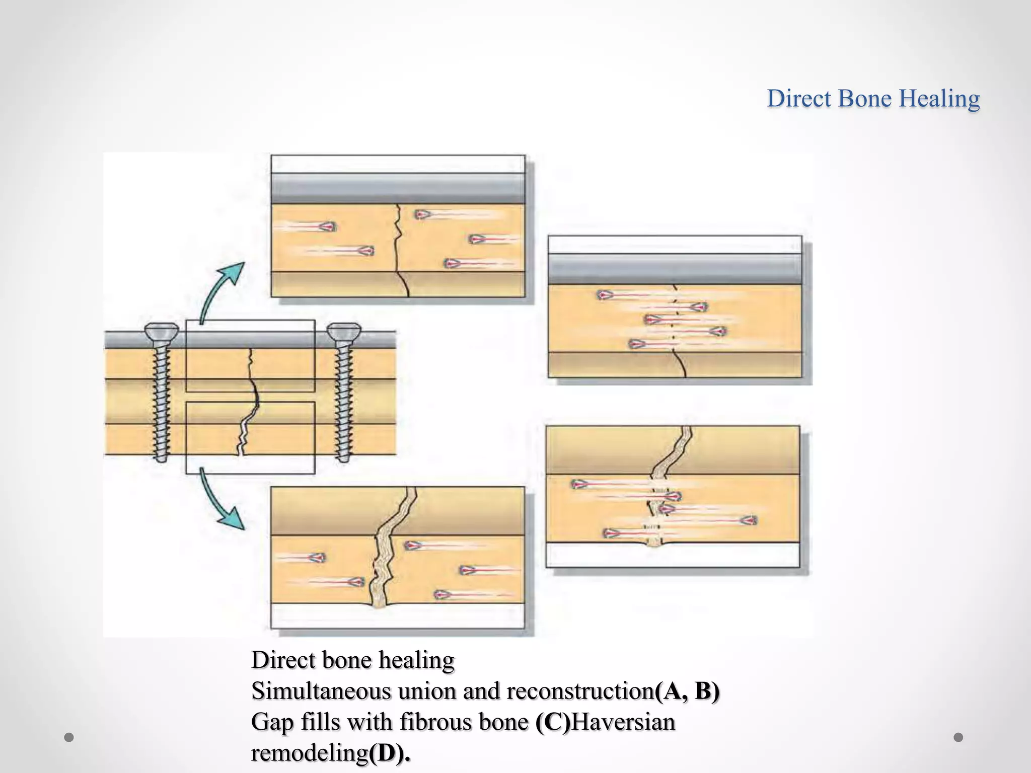 Fracture healing, complication & factors promotes the fracture healing ...