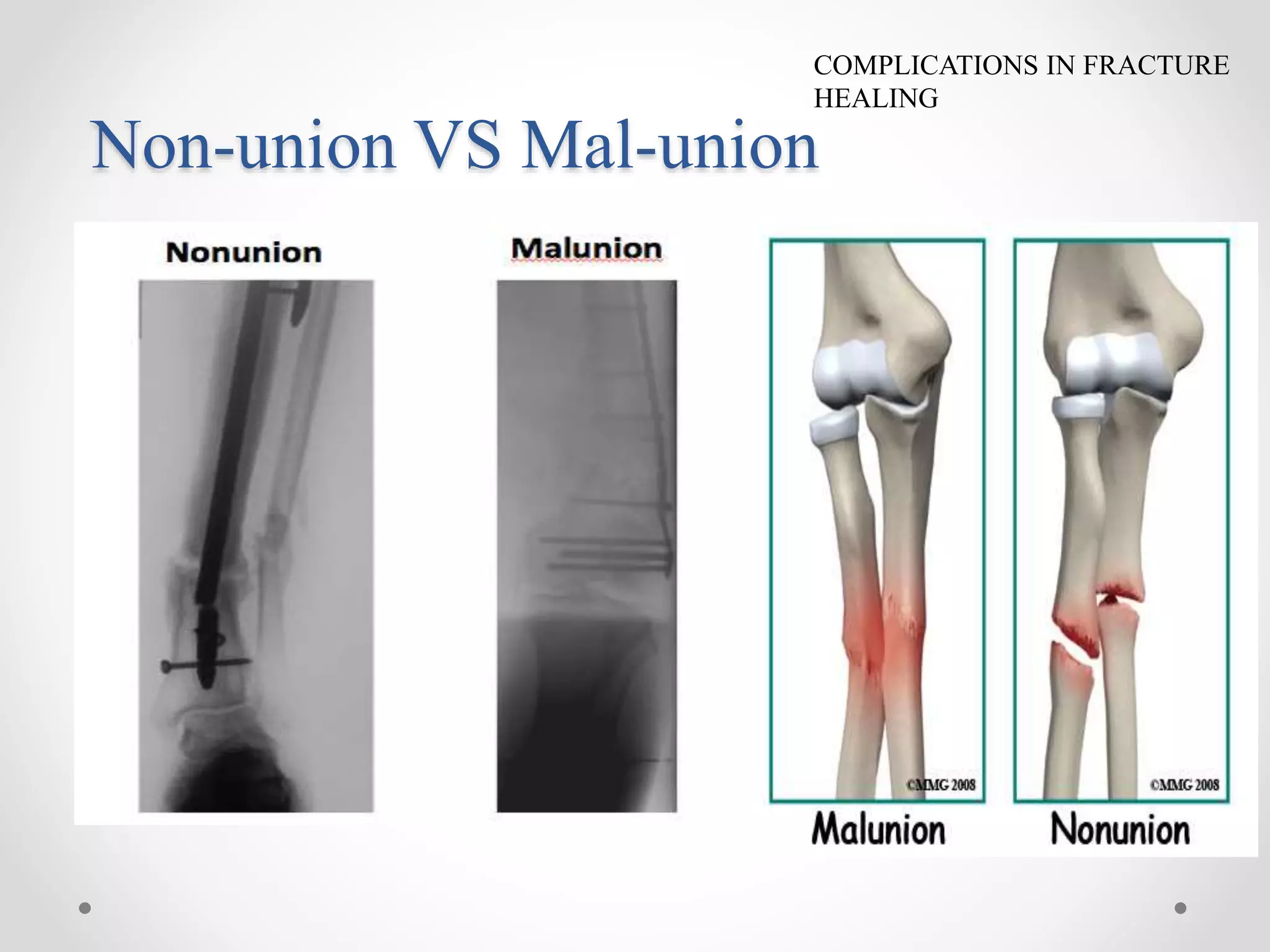 Fracture healing, complication & factors promotes the fracture healing ...