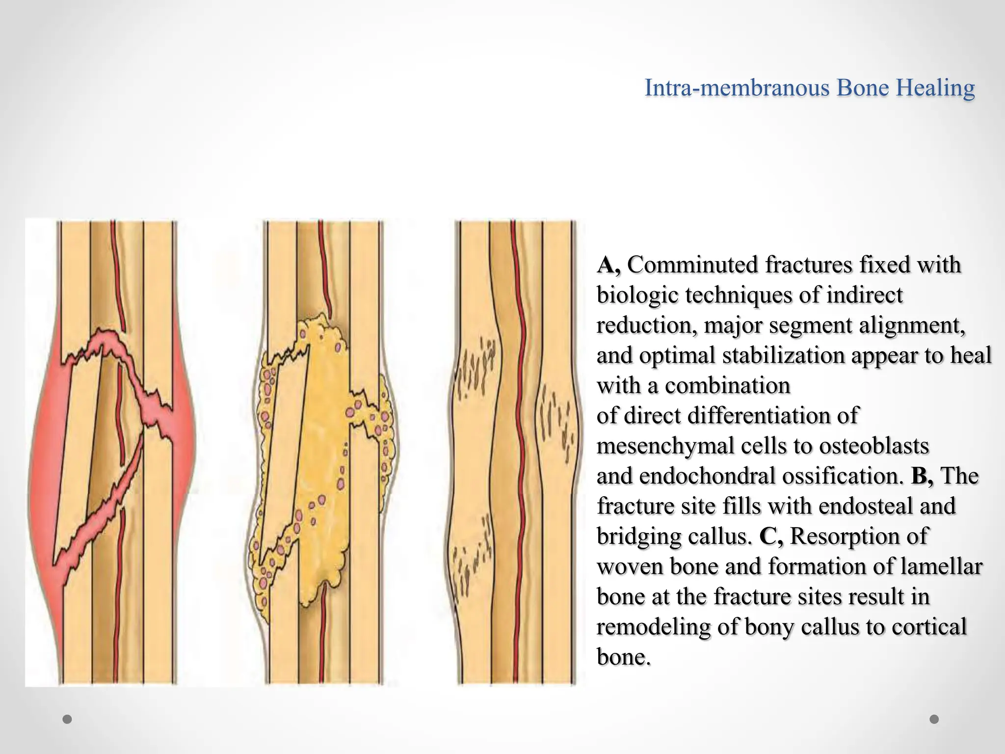 Fracture Healing, Complications & factors promotes the fracture healing ...
