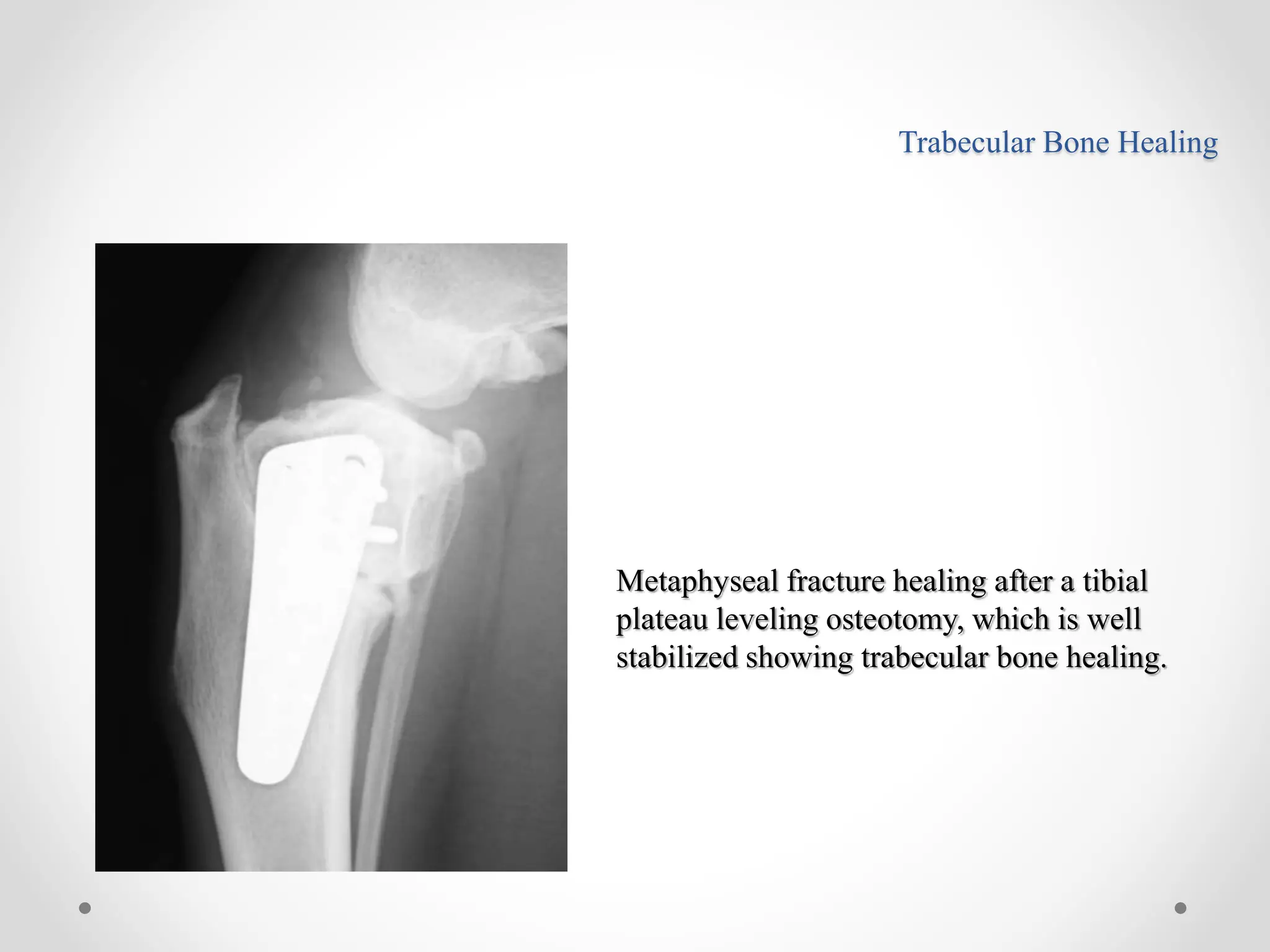 Fracture Healing, Complications & factors promotes the fracture healing ...