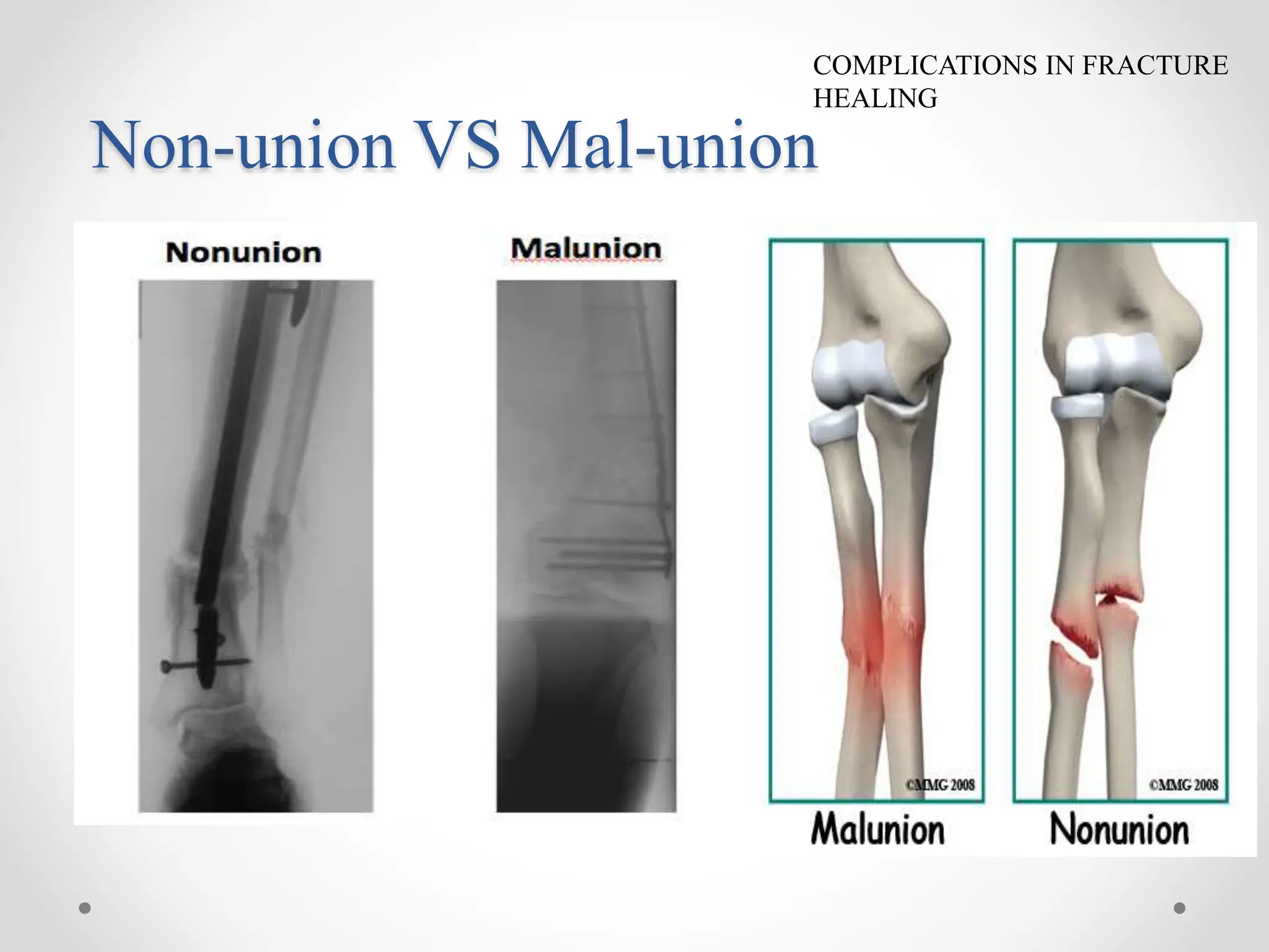 Fracture Healing, Complications & factors promotes the fracture healing ...
