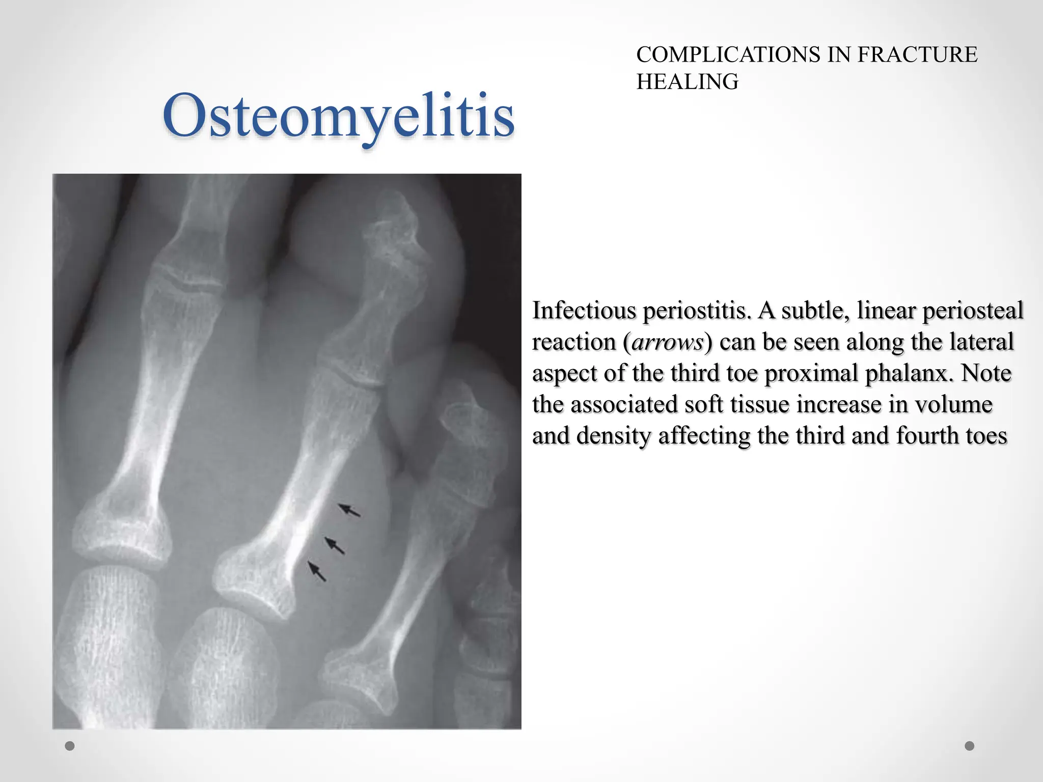 Fracture Healing, Complications & factors promotes the fracture healing ...