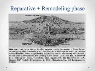 Fracture Healing, Complications & factors promotes the fracture healing ...
