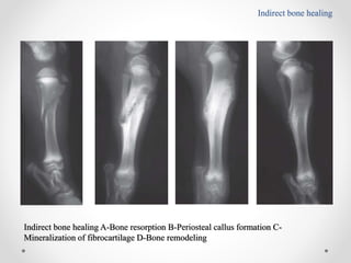Fracture Healing, Complications & factors promotes the fracture healing ...