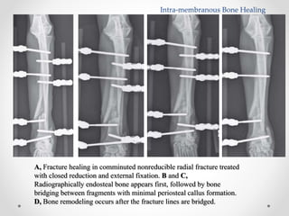 Fracture Healing, Complications & factors promotes the fracture healing ...