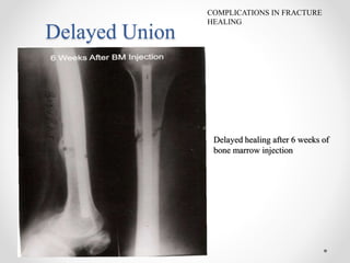 Fracture Healing, Complications & factors promotes the fracture healing ...