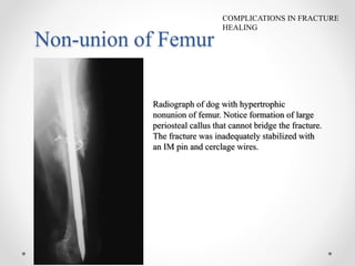 Fracture Healing, Complications & factors promotes the fracture healing ...