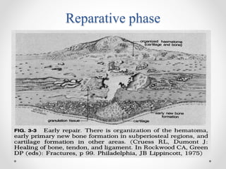 Fracture Healing, Complications & factors promotes the fracture healing ...