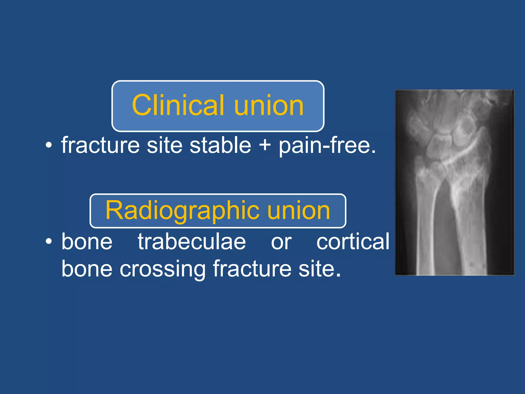 Fracture healing latest | PPTX