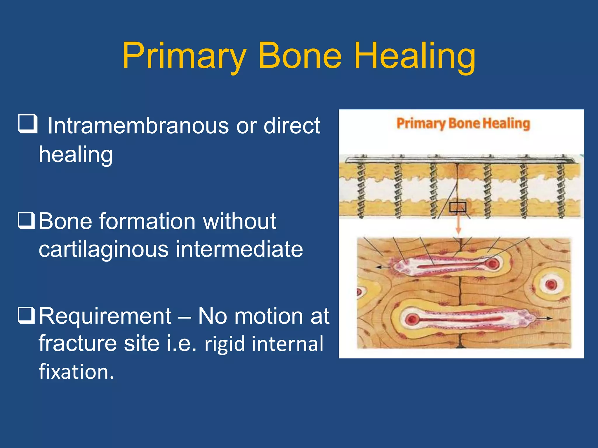 Fracture healing latest | PPTX