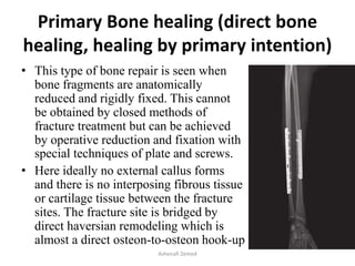 Fracture Healing Methods.pptx