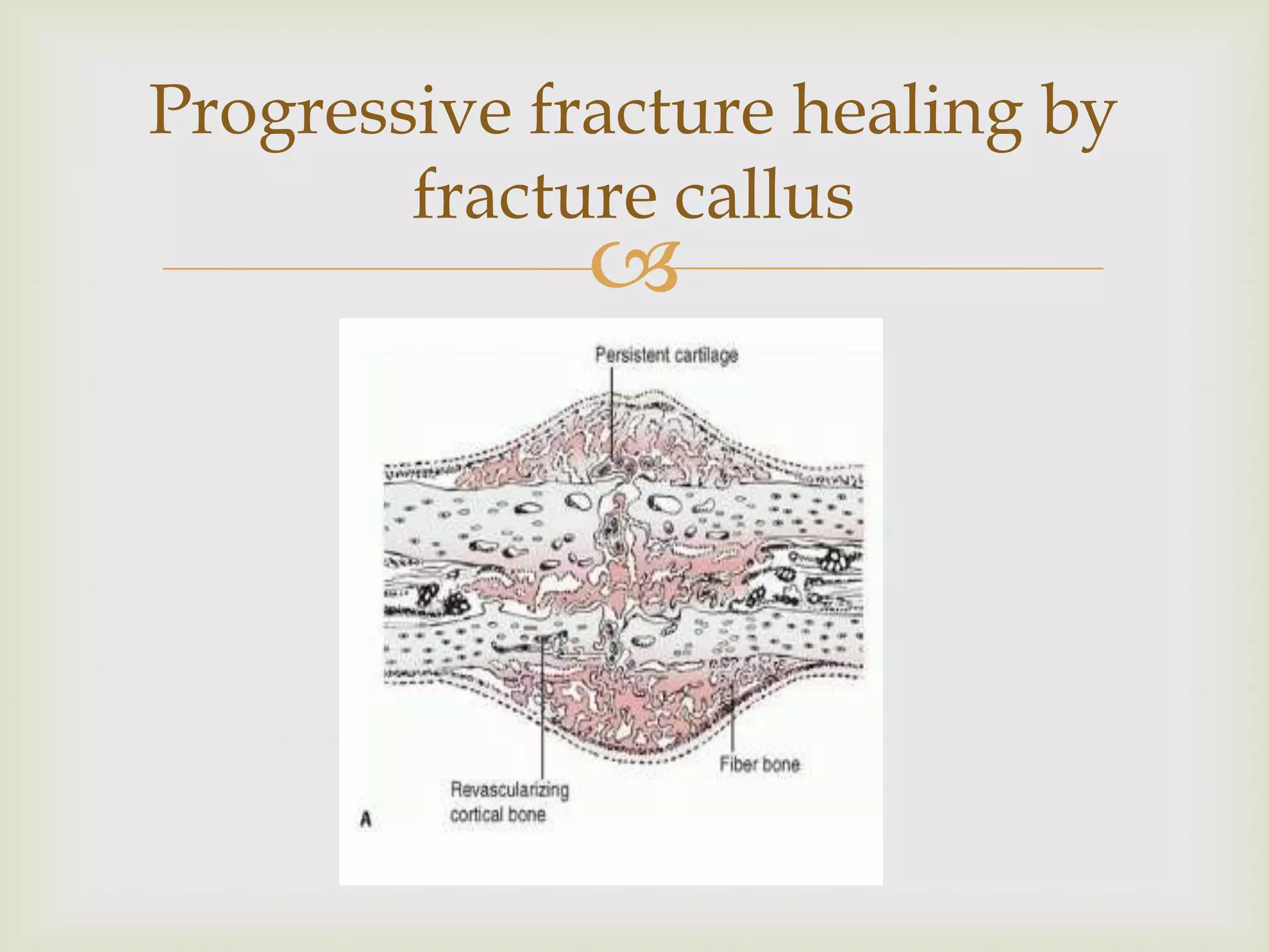 Fracture healing,stages& Factors affecting fracture healing | PPTX