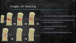 Fracture healing stages and complications | PPTX