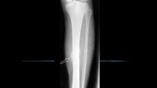 Fracture healing stages and complications | PPTX
