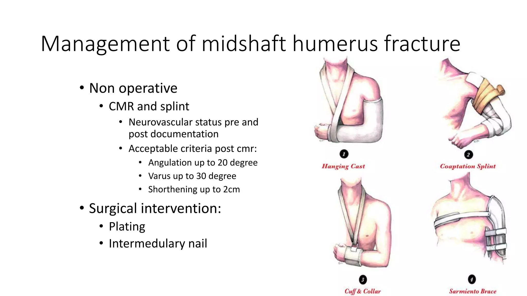 Fracture humerus with radial nerve injury | PPTX