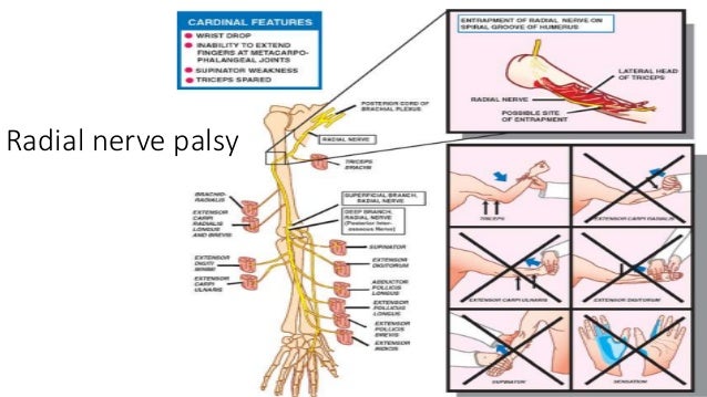 Fracture humerus with radial nerve injury