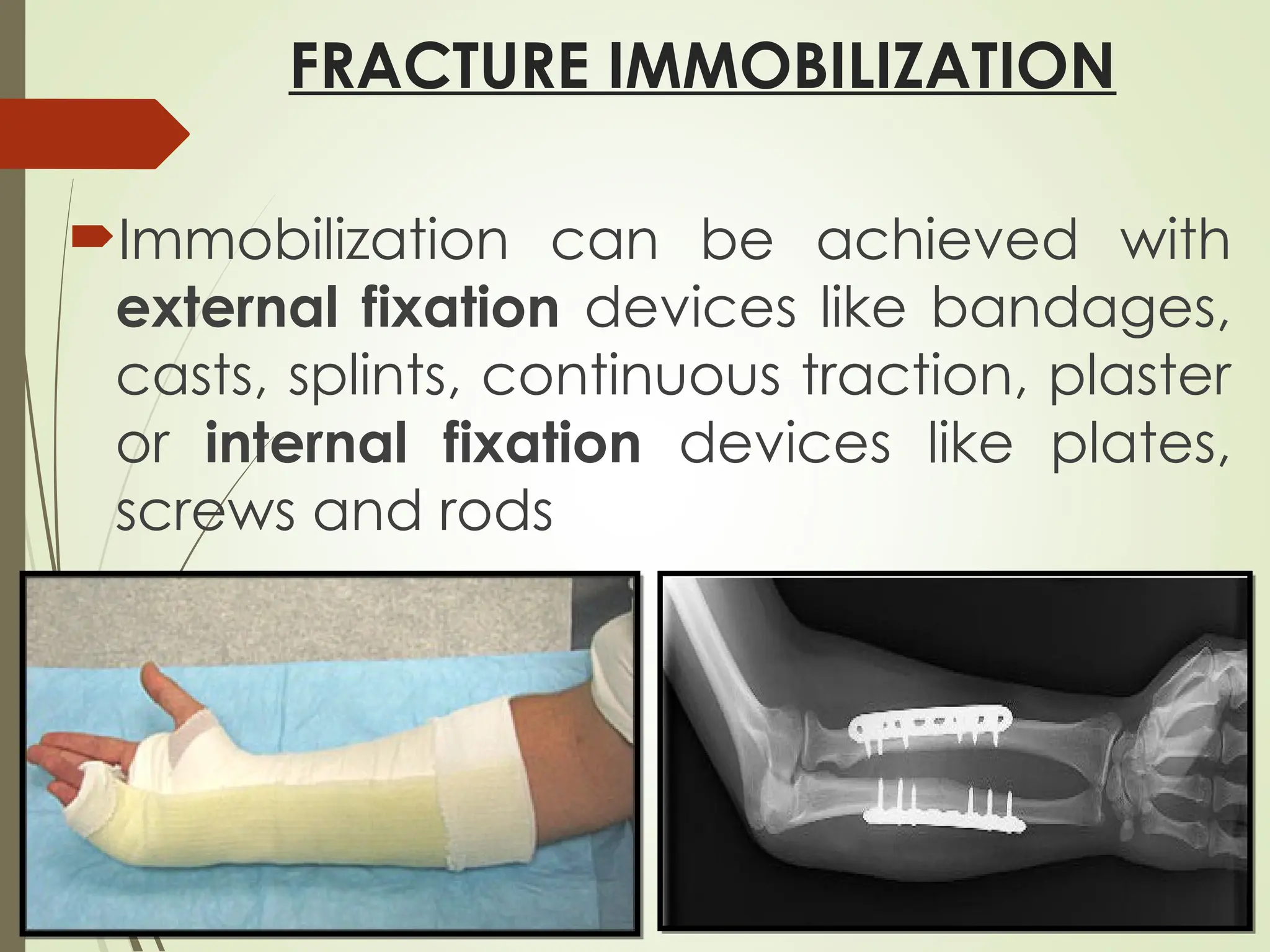 FRACTURE IN PEDIATRICS .ppt