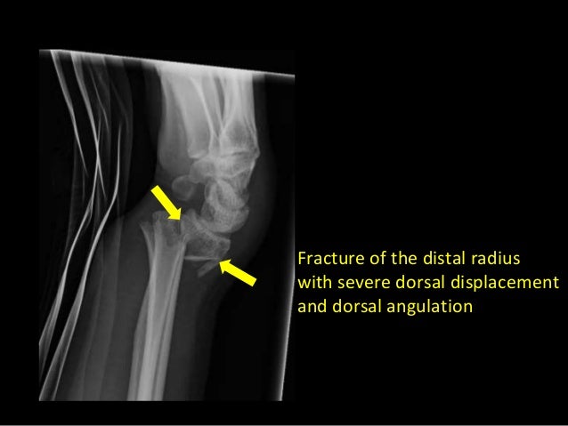 Fracture interpretation for medical students