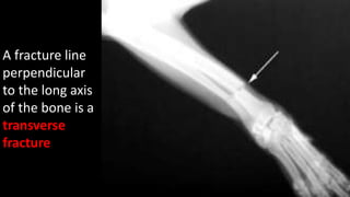 Fracture its types classification and manangment | PPTX