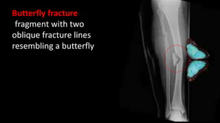 Fracture its types classification and manangment | PPT