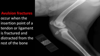 Fracture its types classification and manangment | PPTX