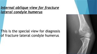 FRACTURE LATERAL CONDYLE HUMERUS BY DR KARAJ SANDHU.pptx