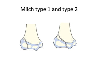 Fracture lateral condyle of humurus in children | PPTX