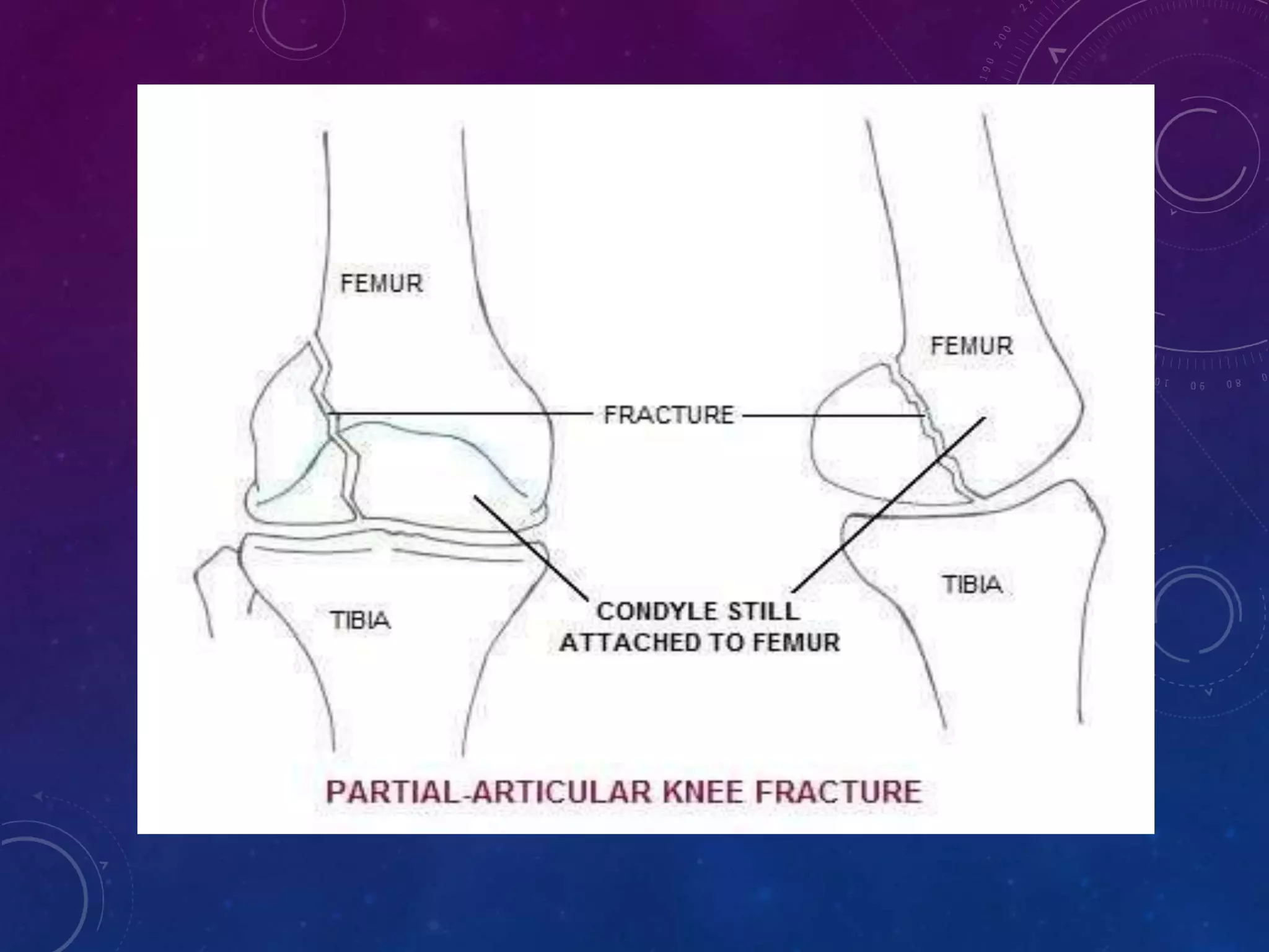 fracture lower limb.pptx