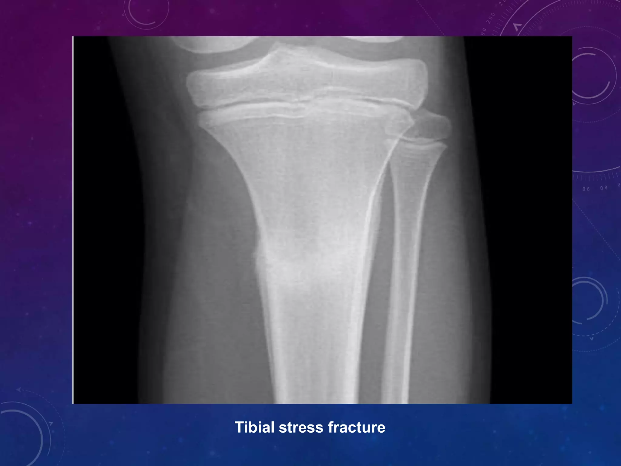 fracture lower limb.pptx