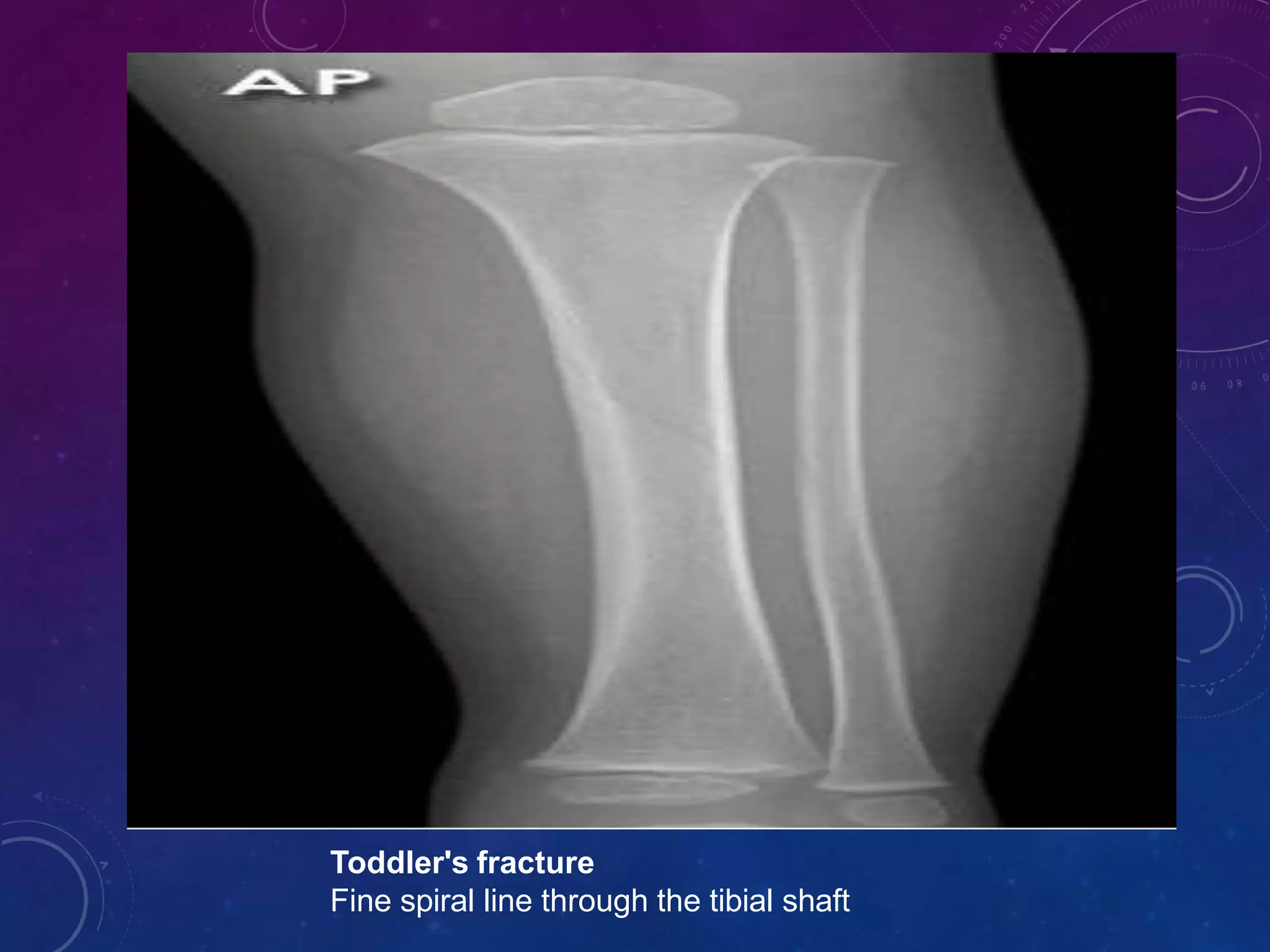 fracture lower limb.pptx