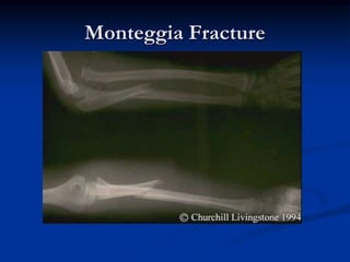 fracture management.ppt