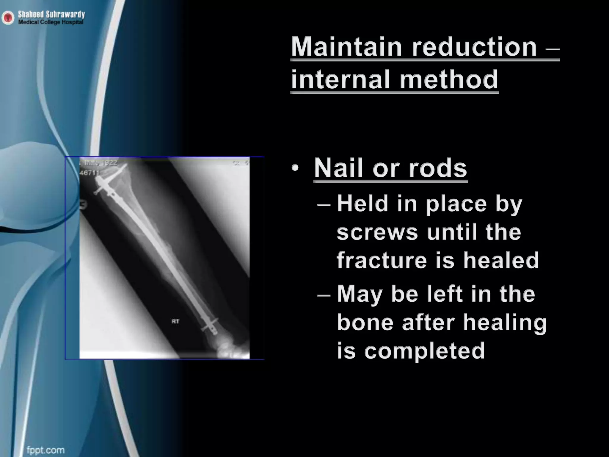 Fracture management -Basic | PPTX