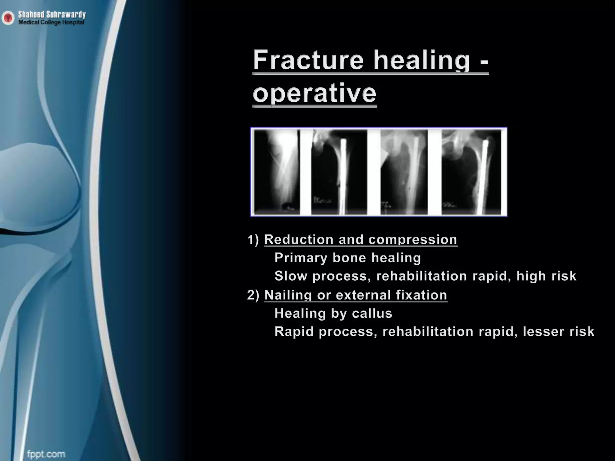Fracture management -Basic | PPTX