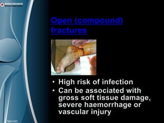 Fracture management -Basic | PPTX