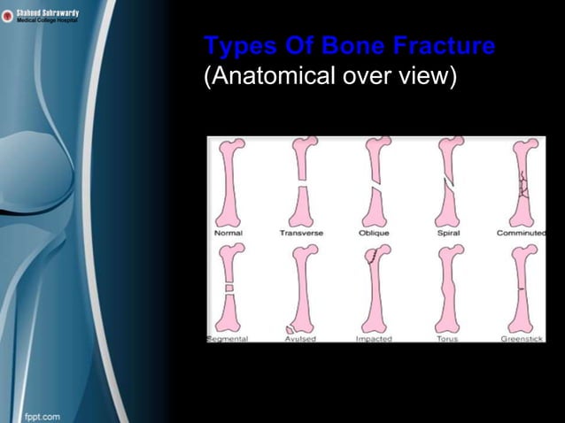 Fracture management -Basic | PPTX | Death, Injury, or Military Conflict ...