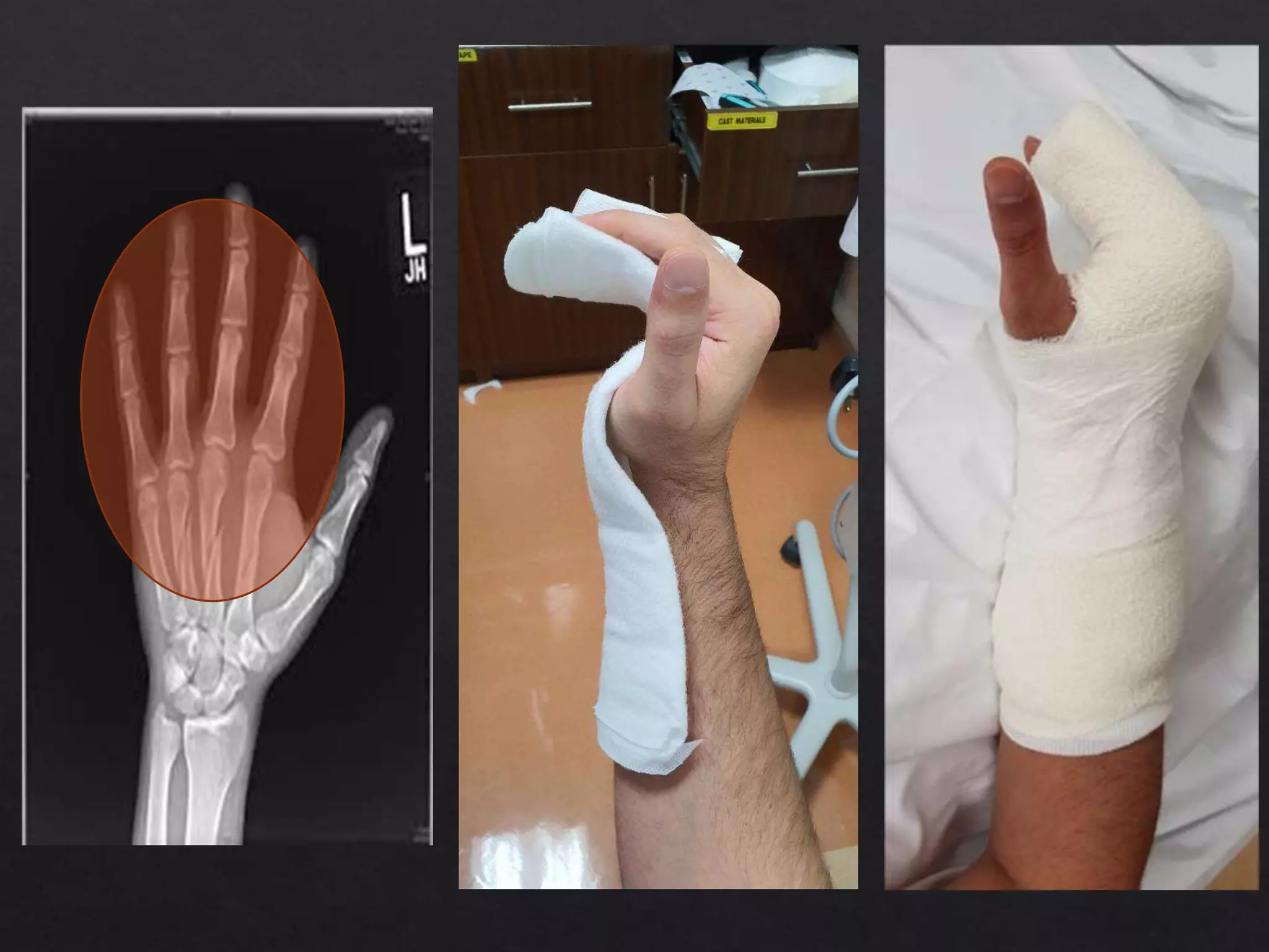 Fracture Management and Immobilization Techniques.pptx