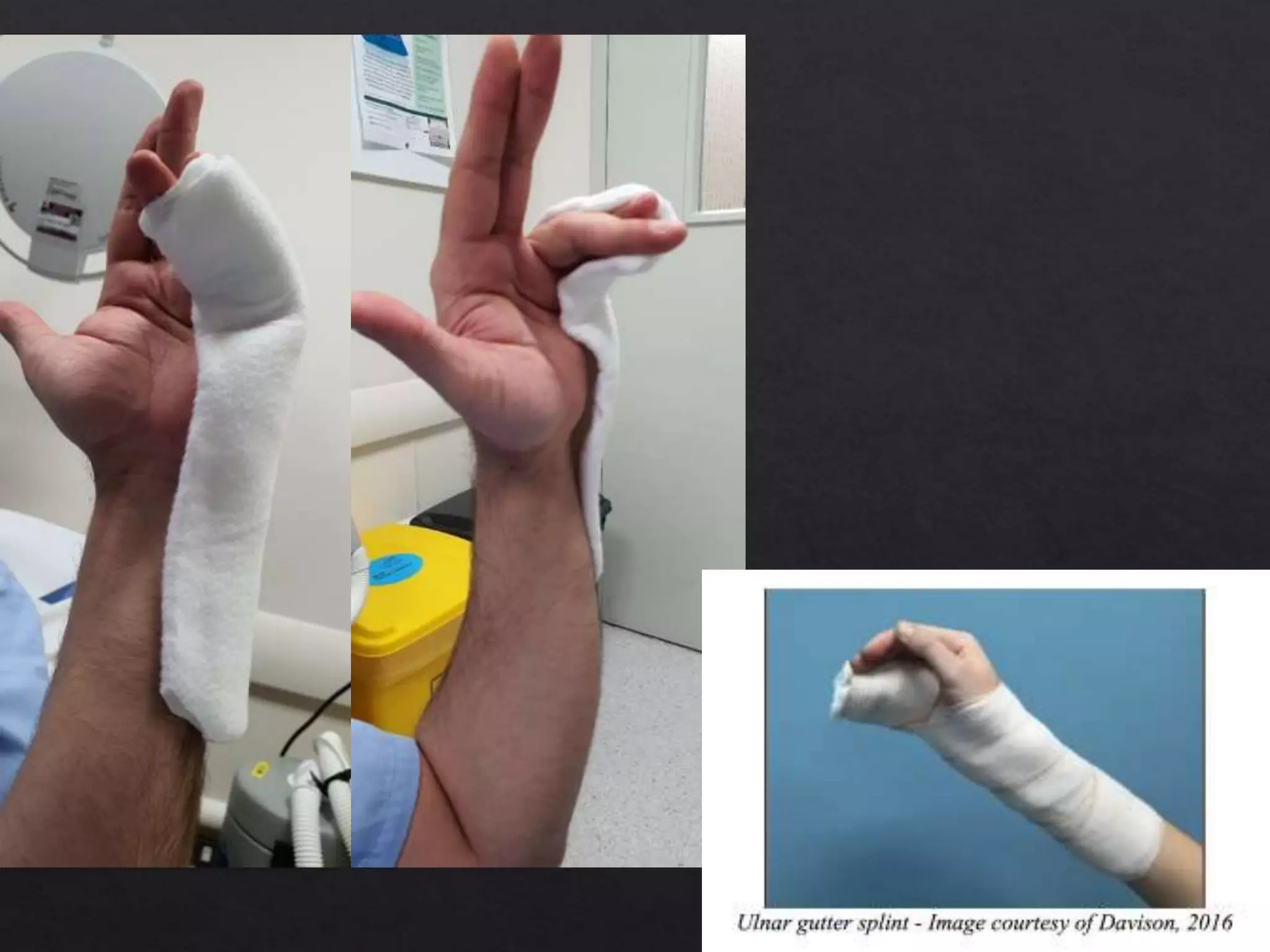 Fracture Management and Immobilization Techniques.pptx