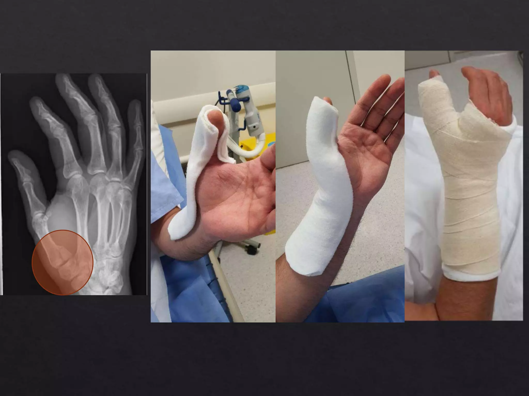Fracture Management and Immobilization Techniques.pptx