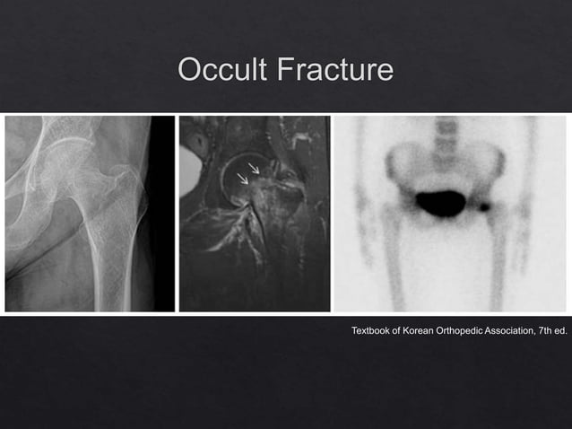Fracture Management and Immobilization Techniques.pptx