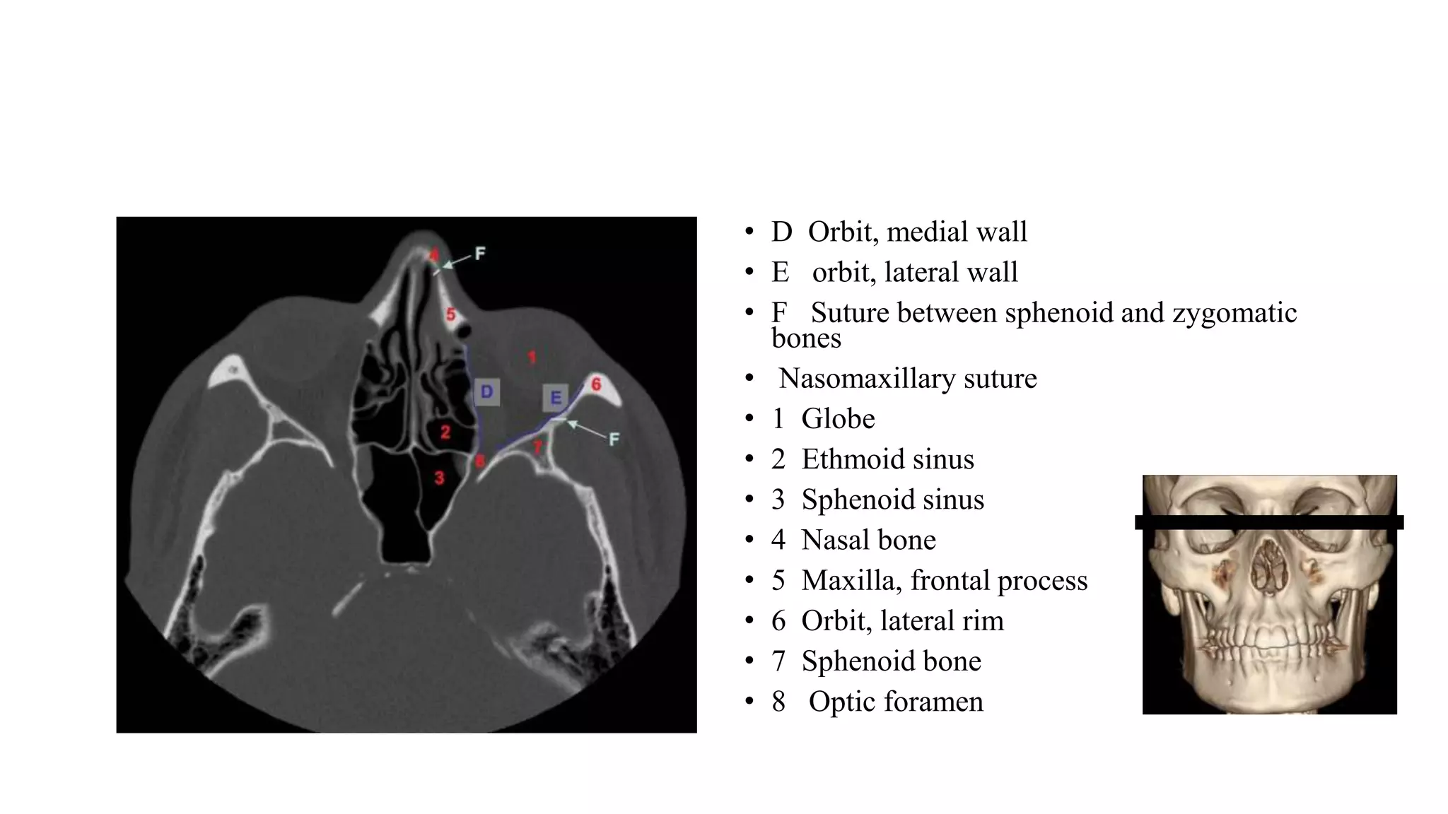 Fracture maxilla | PPTX
