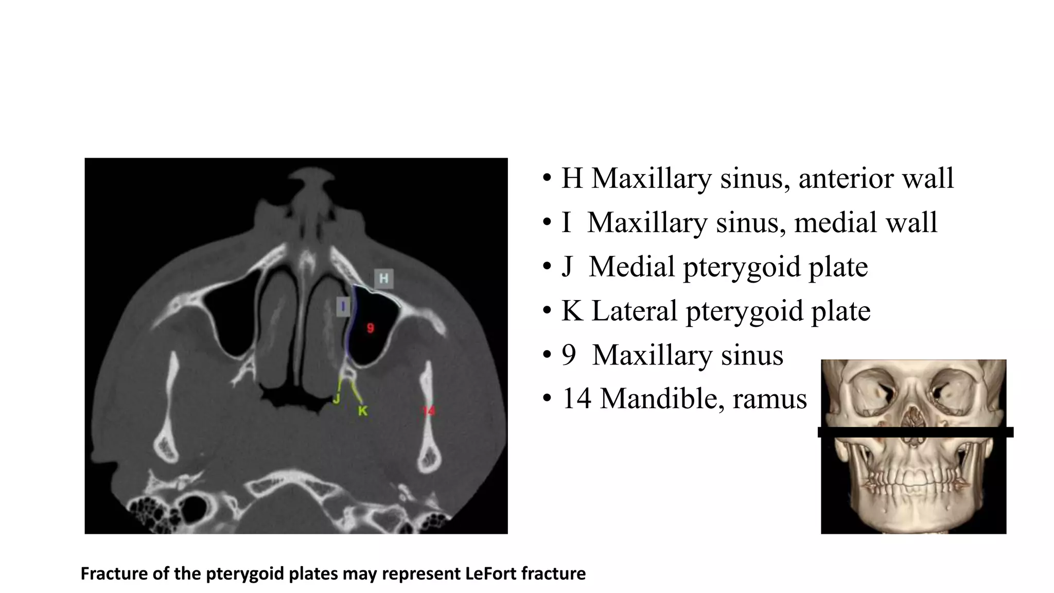 Fracture maxilla | PPTX