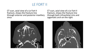 Fracture maxilla | PPTX