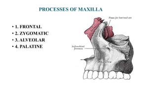 Fracture maxilla