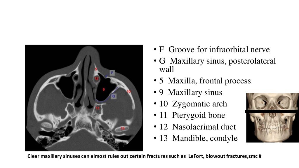 Fracture maxilla